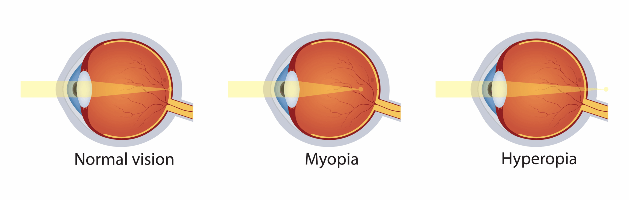 Is Your Child’s Vision Getting Worse Every Year? A Guide to Myopia ...